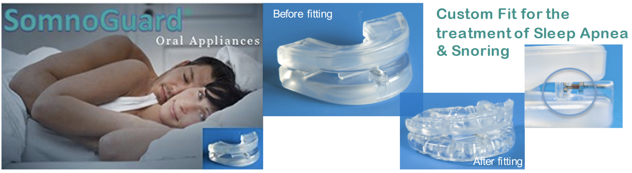 SomnoGuard Oral Appliance Therapy for Snoring & Mild-Moderate OSA ...